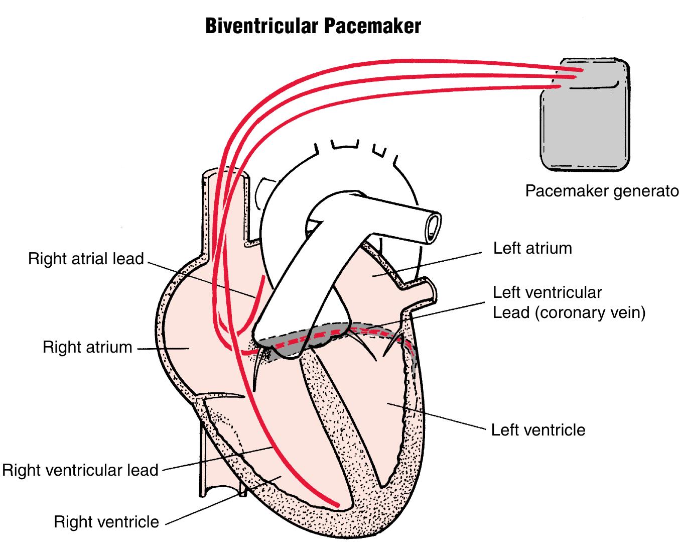 -9. biventricular (biv) pacemaker. note the pacemaker lead