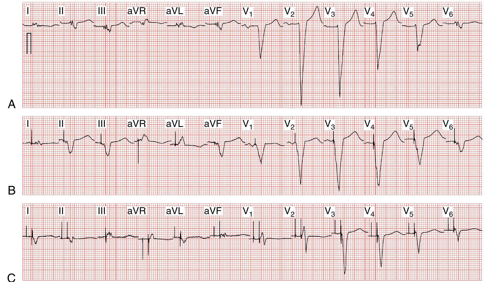 -10. effect of biventricular pacing on qrs width and shape.