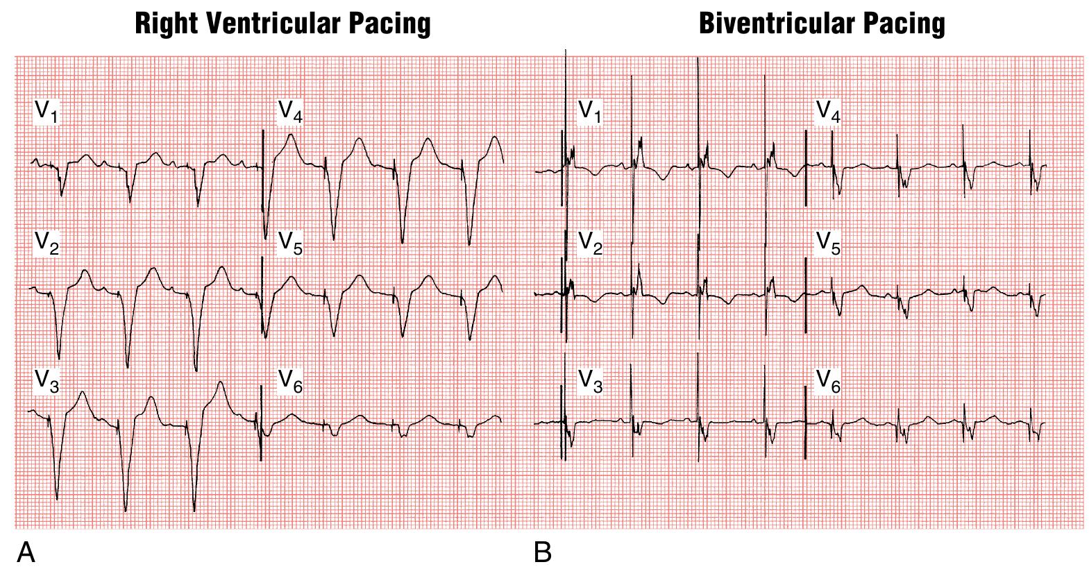 -11. right ventricular and biventricular (biv) pacing. a,