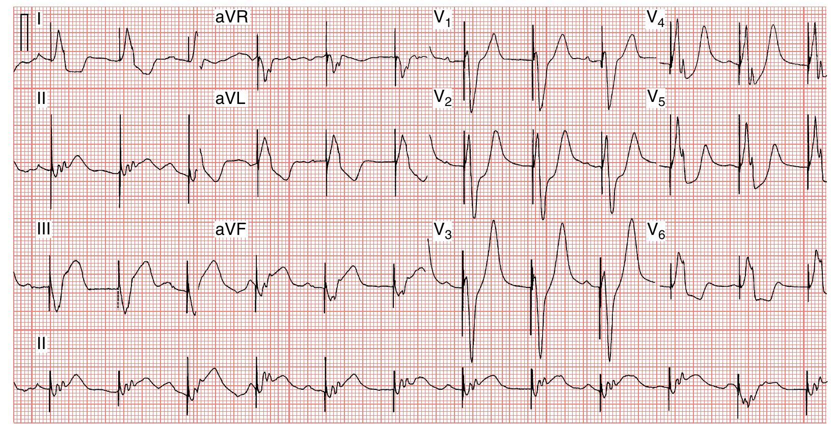 -12. temporary transvenous pacing in a patient with acute