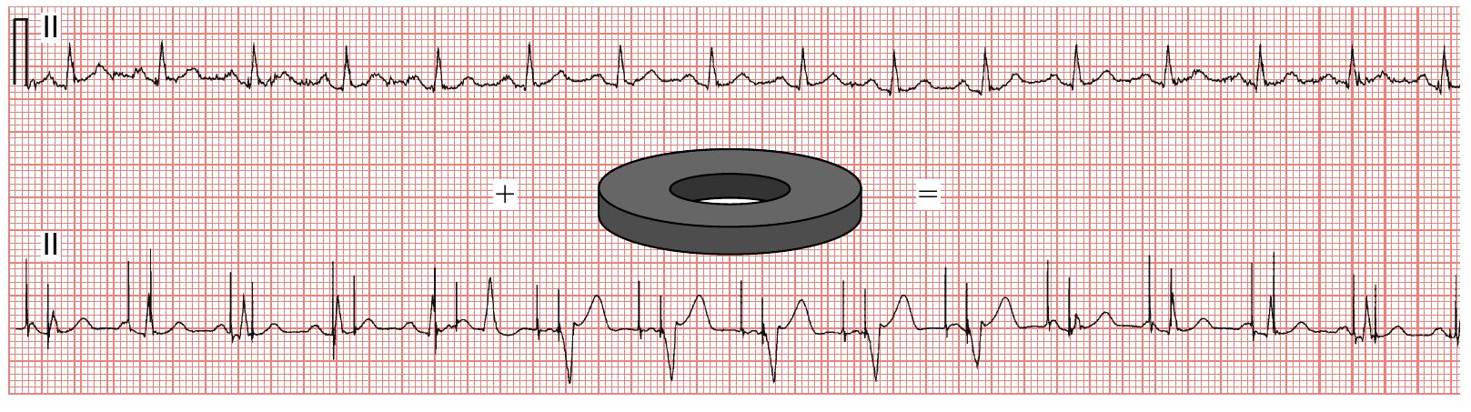 -17. dual-chamber pacemaker response to external magnet