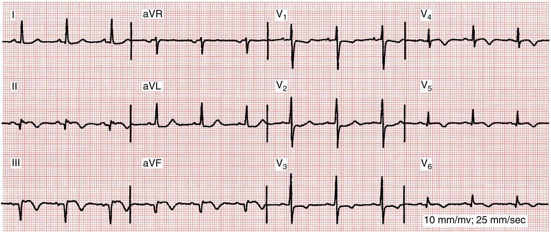 -1. ecg for interpretation: (1) standardization—10 mm/mv; 25