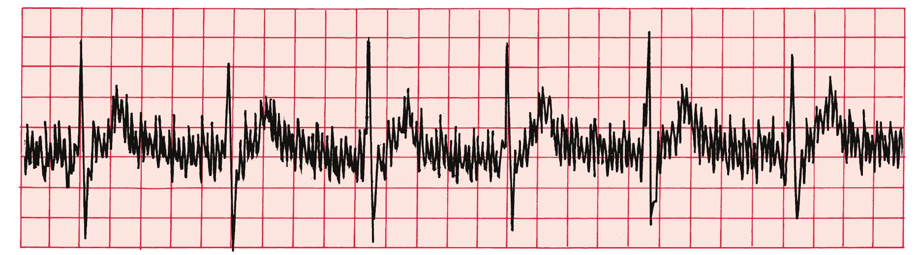 -2. magnified view of ecg highlights rapid oscillations of