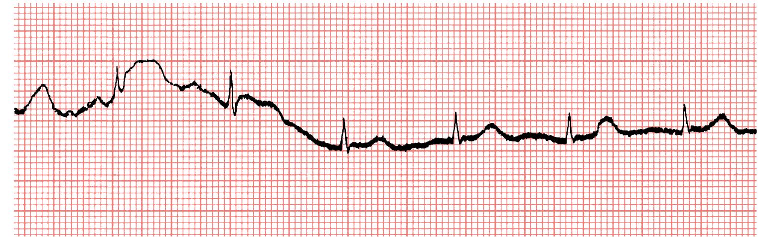 -4. wandering baseline resulting from patient movement or