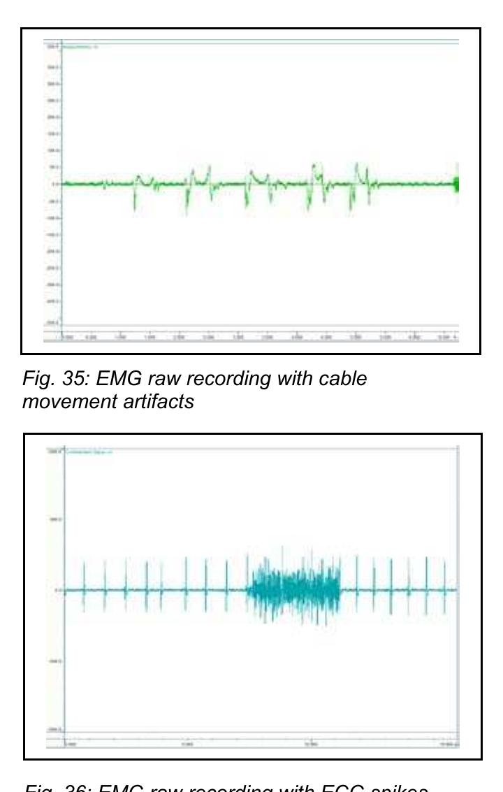 (PDF) ABC of EMG
