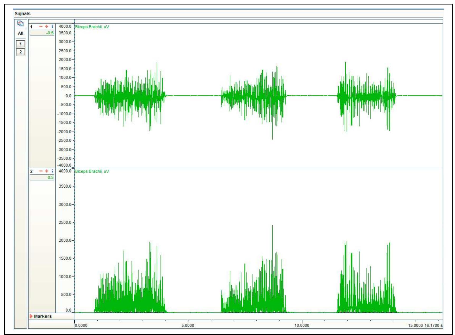 (PDF) ABC of EMG