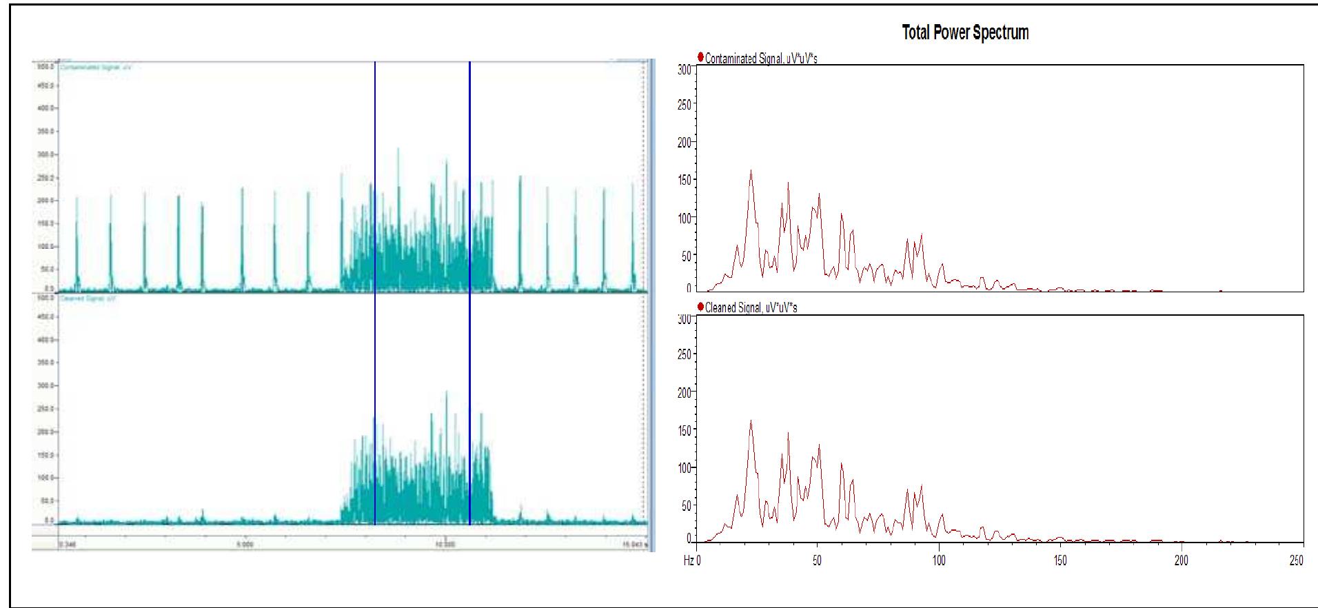 (PDF) ABC of EMG