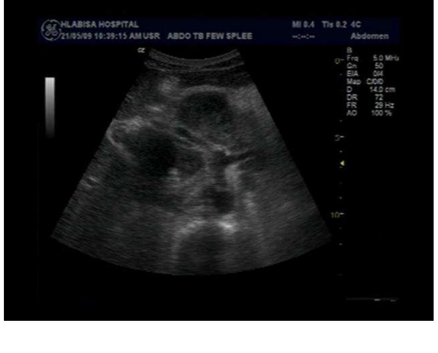 Enlarged lymph nodes encasing the coeliac axis, common