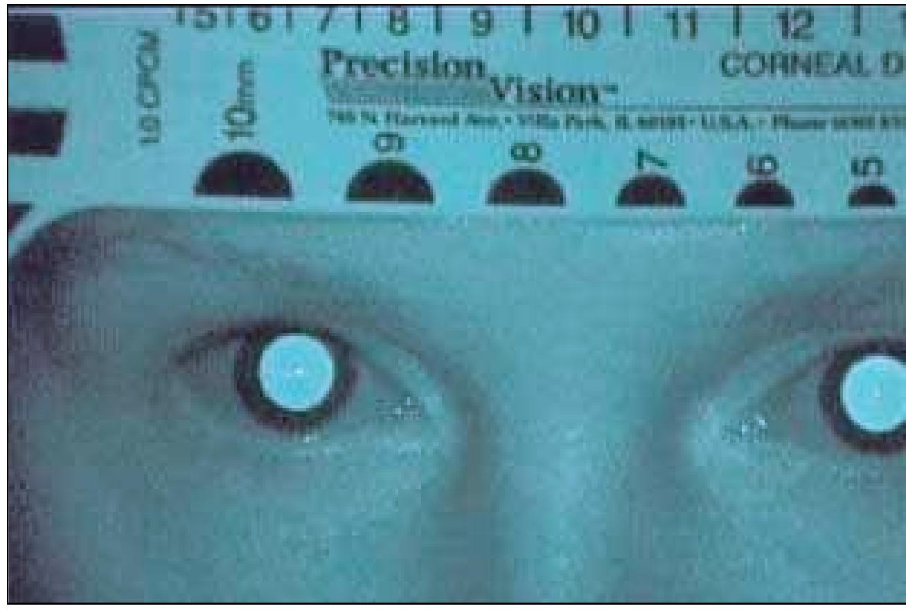 ‘igure measurement with a pupillometer scale using an
