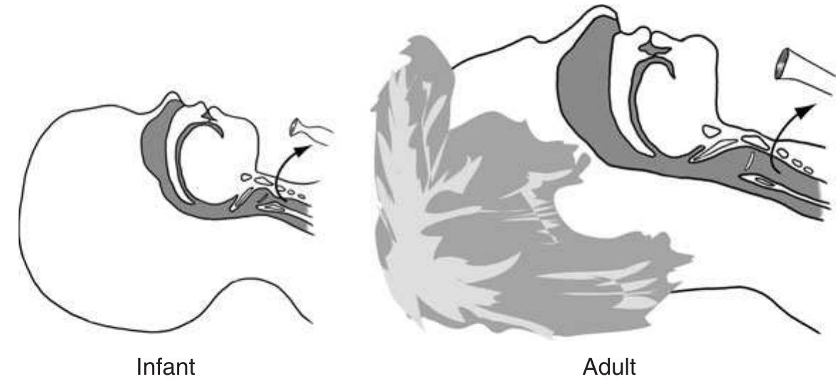 -14. pediatric airway anatomy differences are most apparent