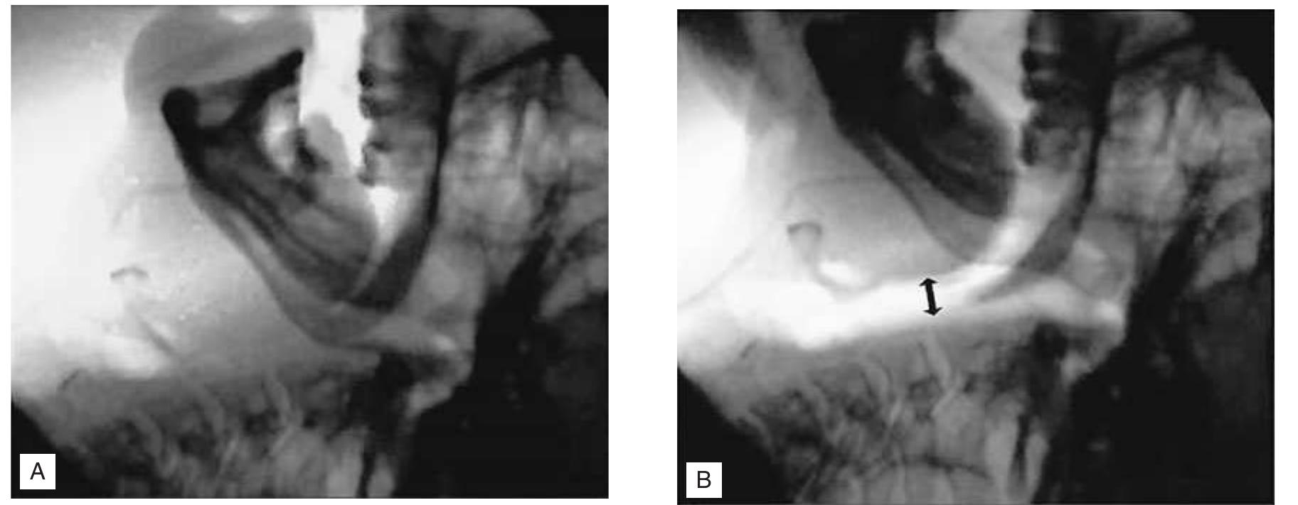 S 4-11. lateral fluoroscopic views of an unconscious
