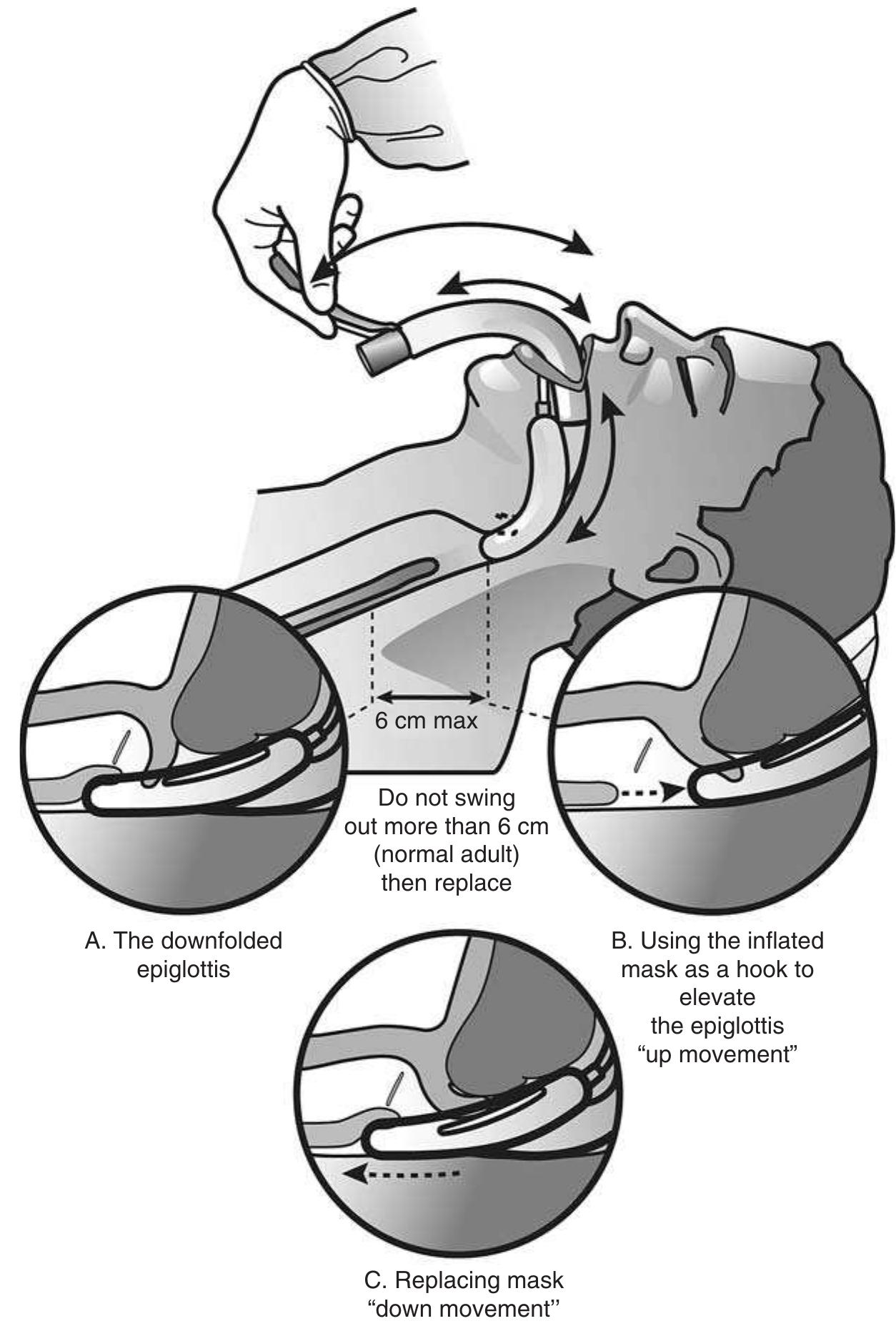 9 An Up Down Maneuver Is Performed To Relieve Potential