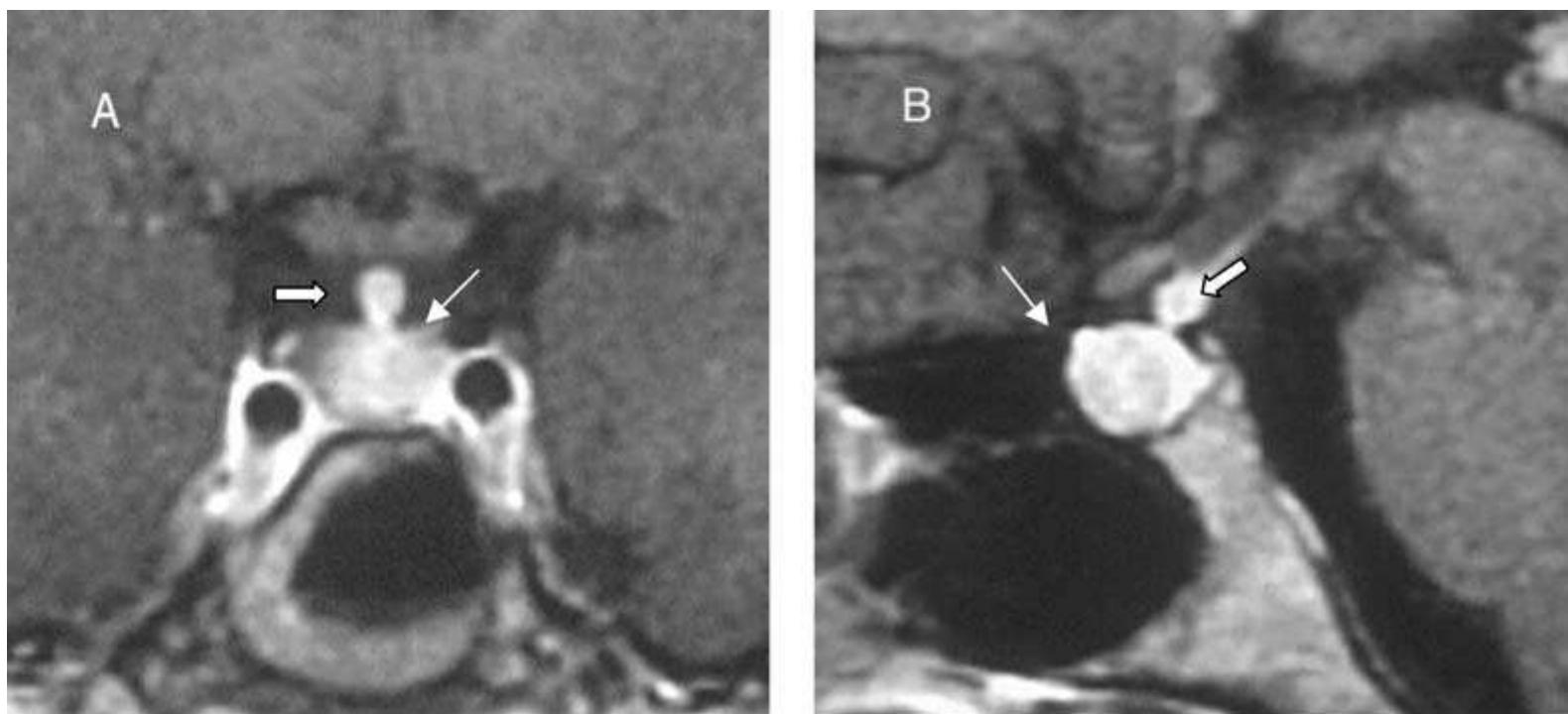 Gadolinium (gd)-enhanced coronal (a) and sagital (b) t1 mri