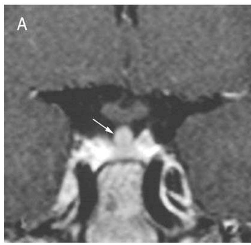 Gd-enhanced coronal t1 mri of the sella turcica showing en-