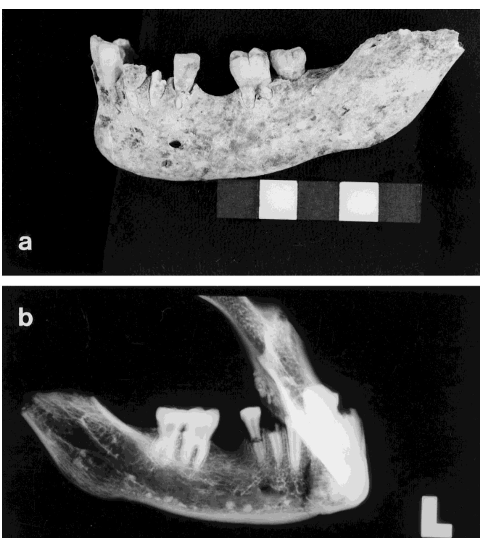 Photograph (a) and radiograph (b) of the left mandible of