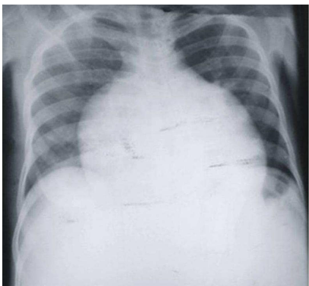Posteroanterior chest radiograph showing gross globular