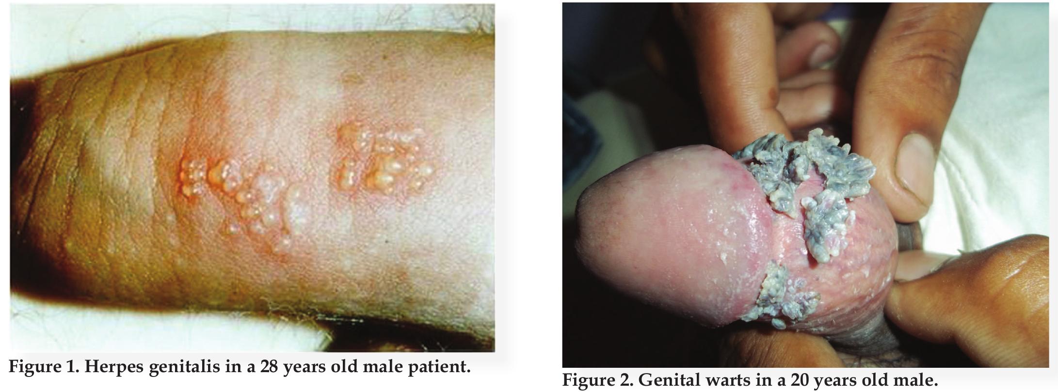 Herpes genitalis in a 28 years old male patient. figure 2.