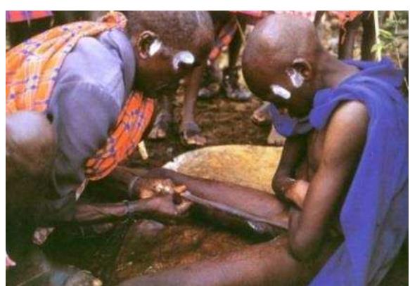 Maasai circumcision a culture bound syndrome is a local
