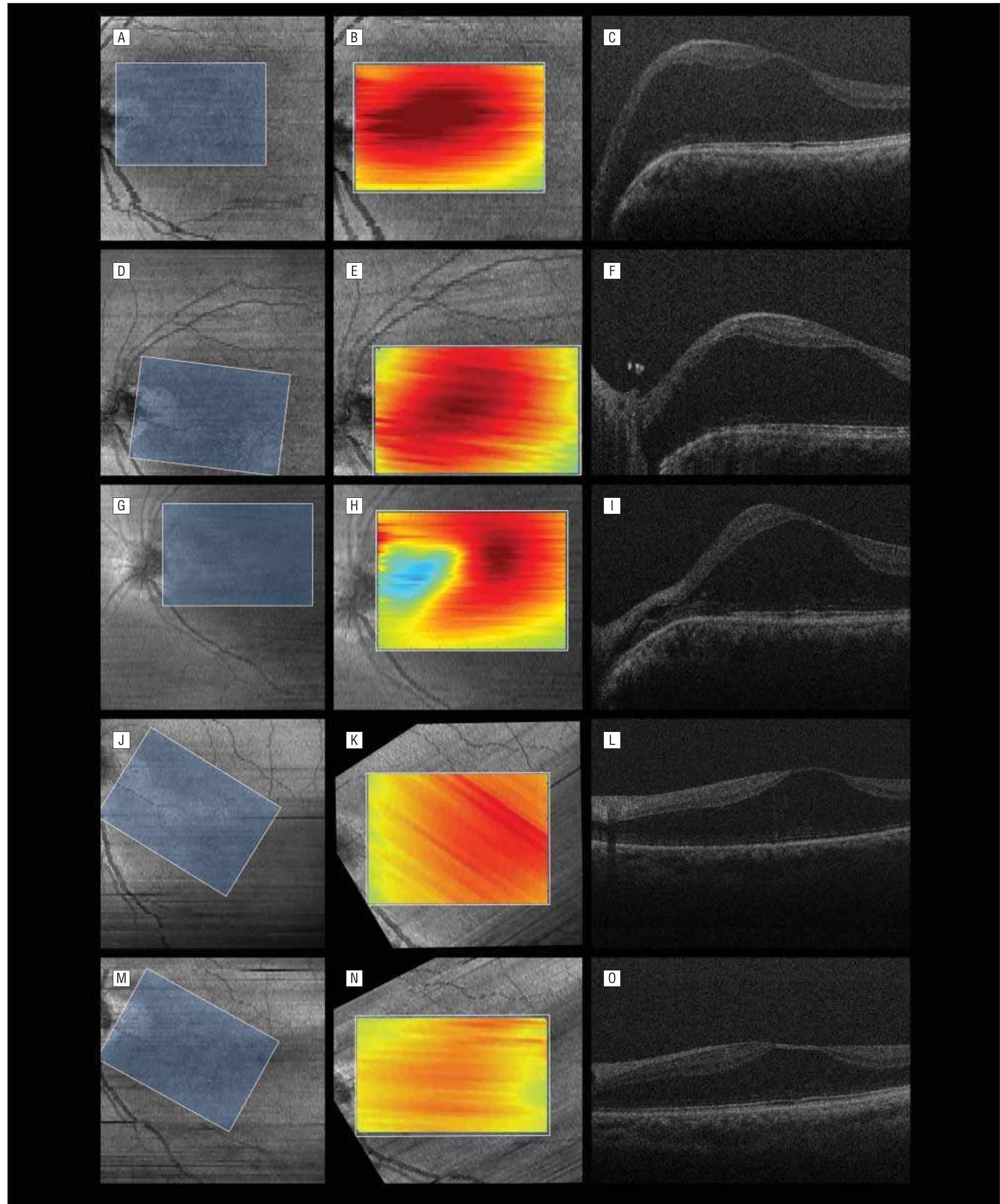 Serial volumetric analysis of overlapping macular areas with