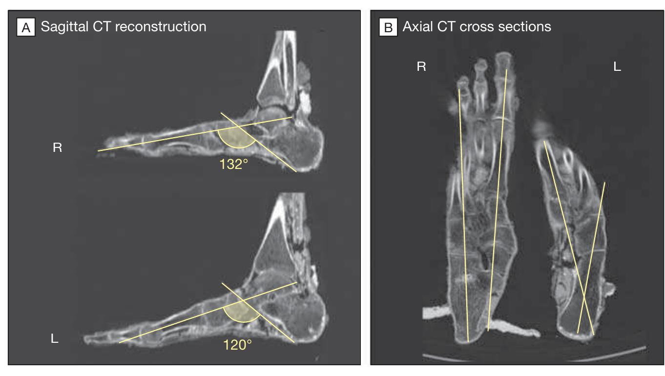 A, as indicated by the angle between the axis of the first