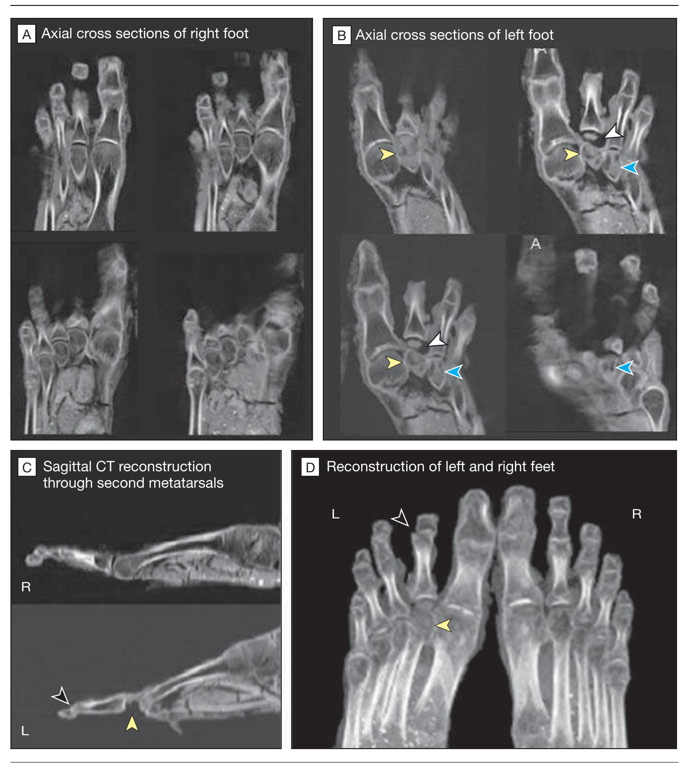 Figure 4 - from Ancestry and pathology in King Tutankhamun's