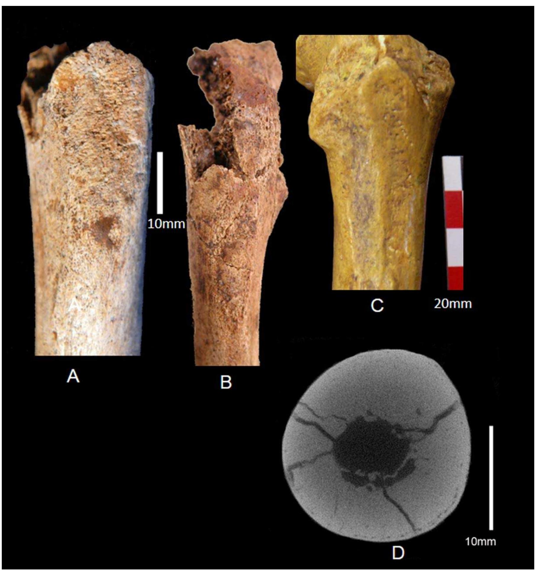 A,b, and c: comparison of the hypotrochanteric fossa of