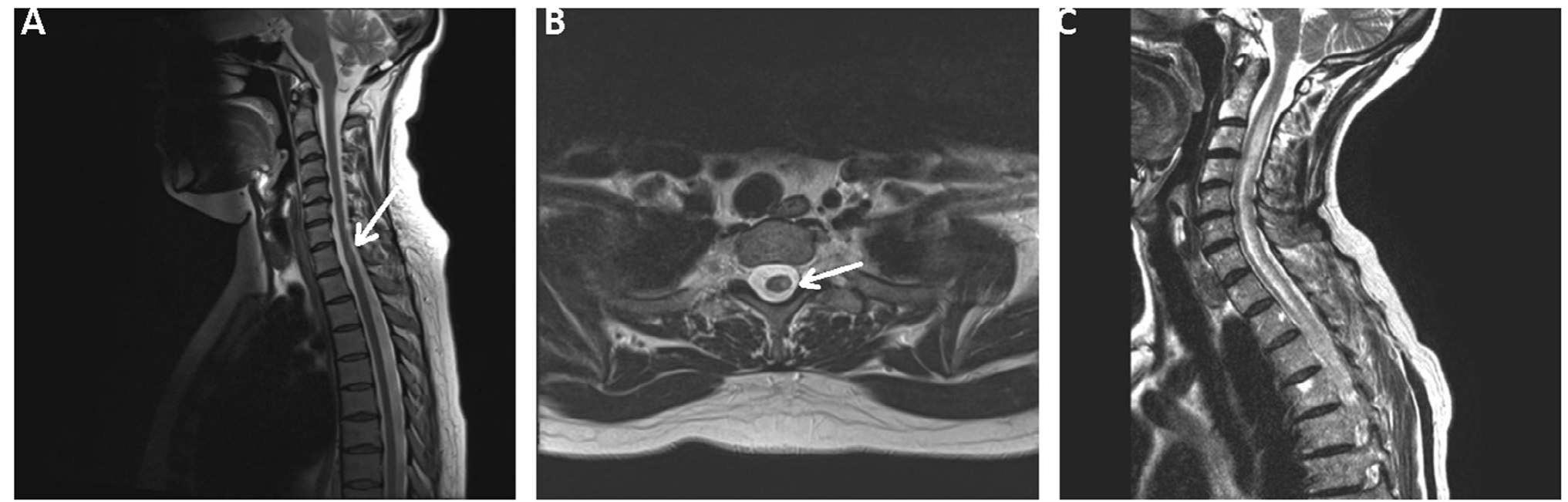(a) sagittal and (b) axial t2-weighted mri showing a typical