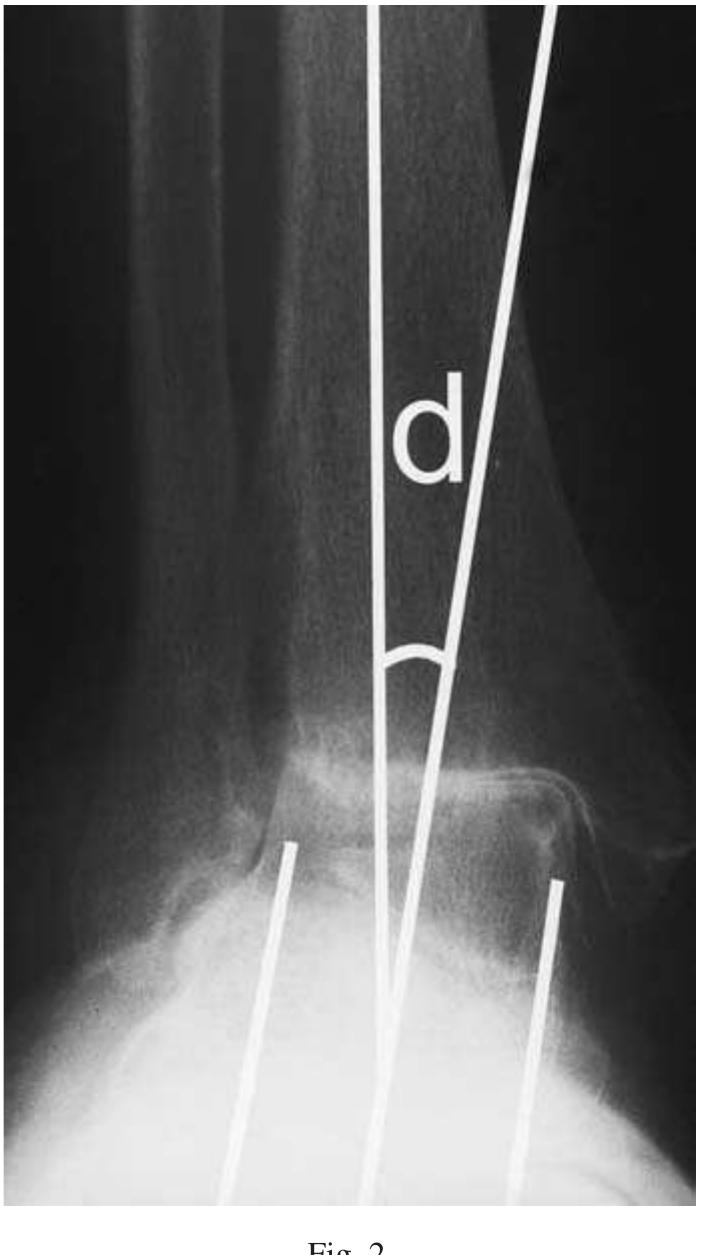 Ap radiograph showing angular measurement of the