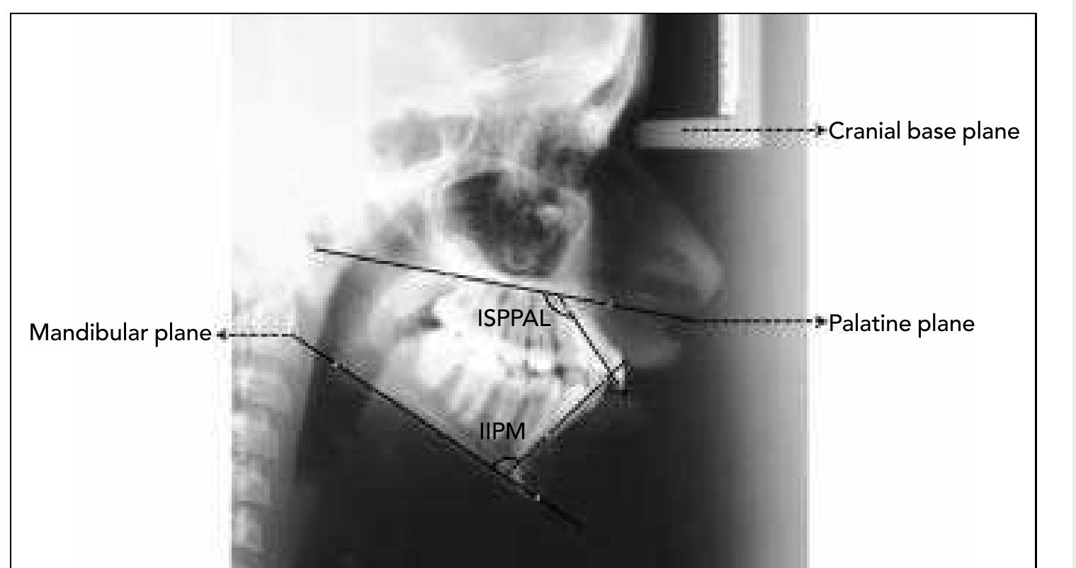 Palatine, mandibular, and cranial base planes in the