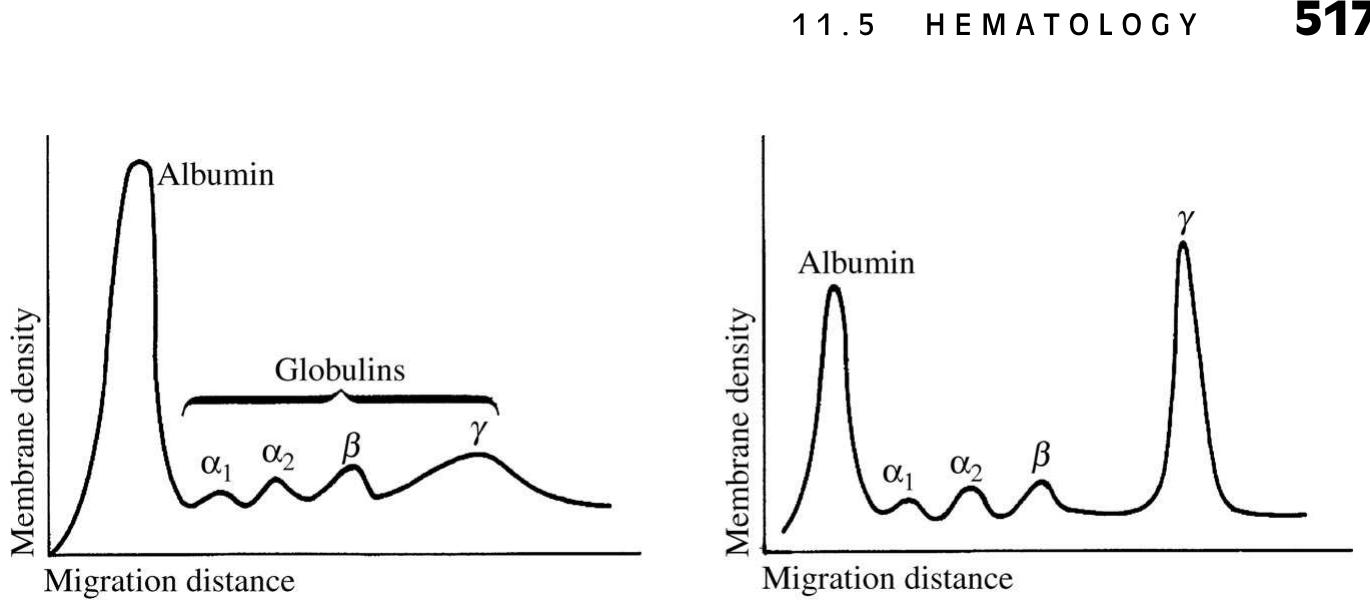 7 examples of patterns of serum protein electrophoresis the