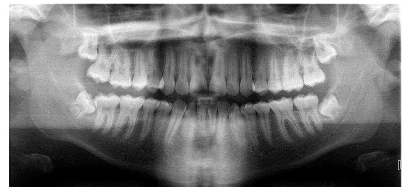 Normal orthopantomogram