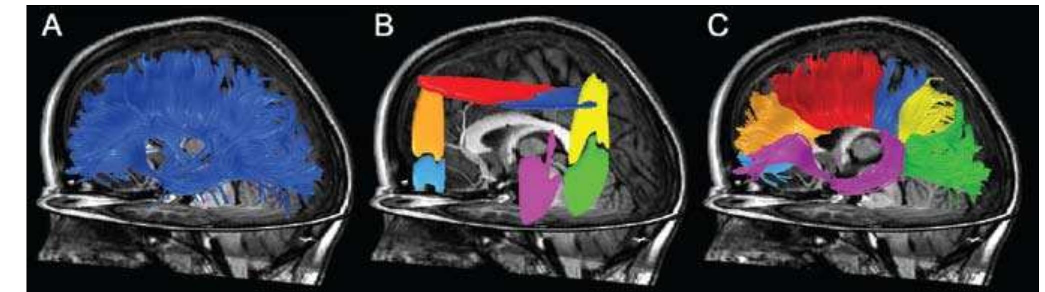 1. segmenting a child’s corpus callosum. their diffusion