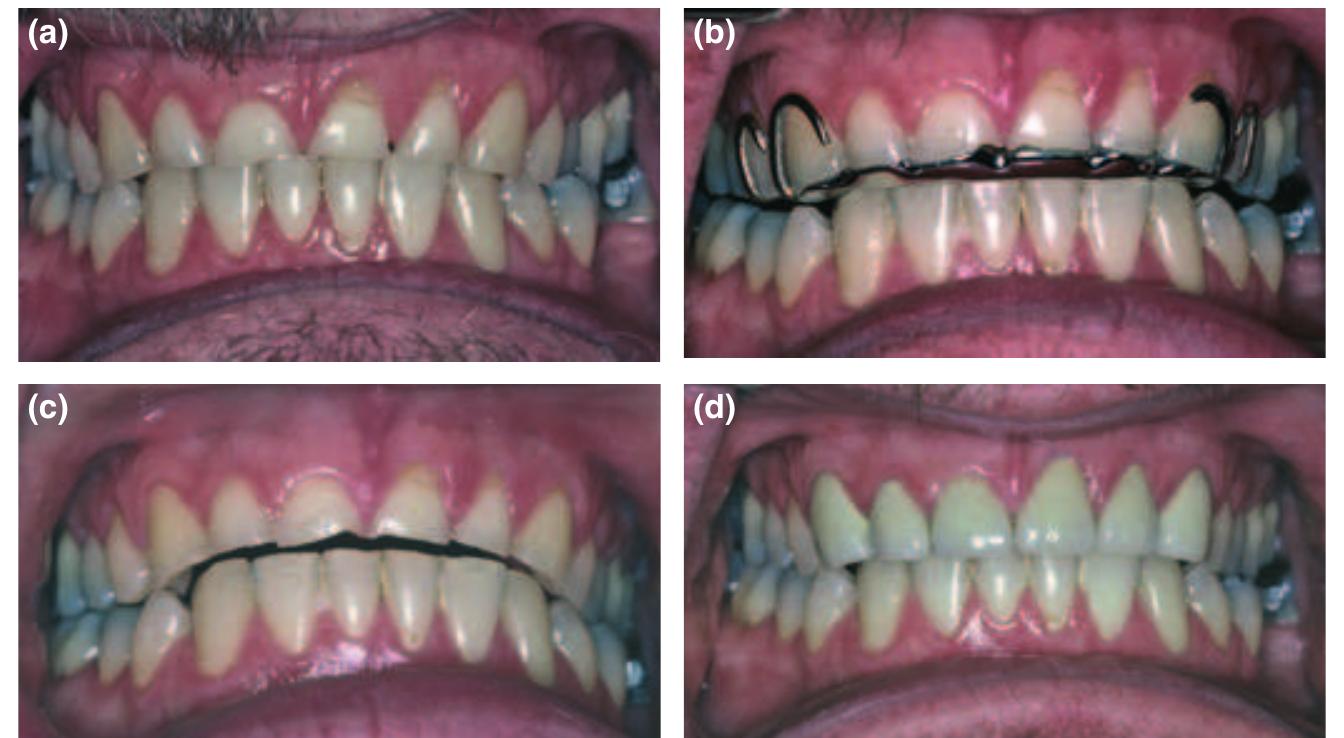 A 36-year-old swedish sailor with a long history of frequent