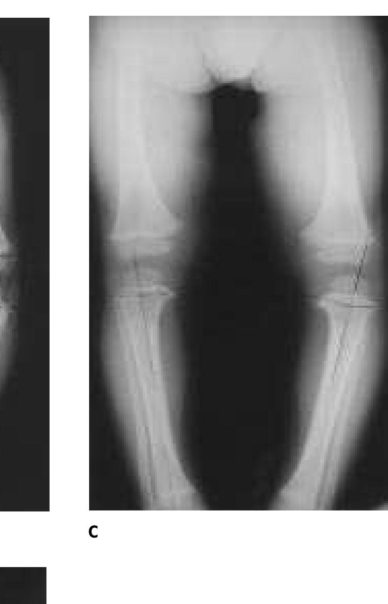 A, clinical appearance of a healthy boy, aged 1 year 9