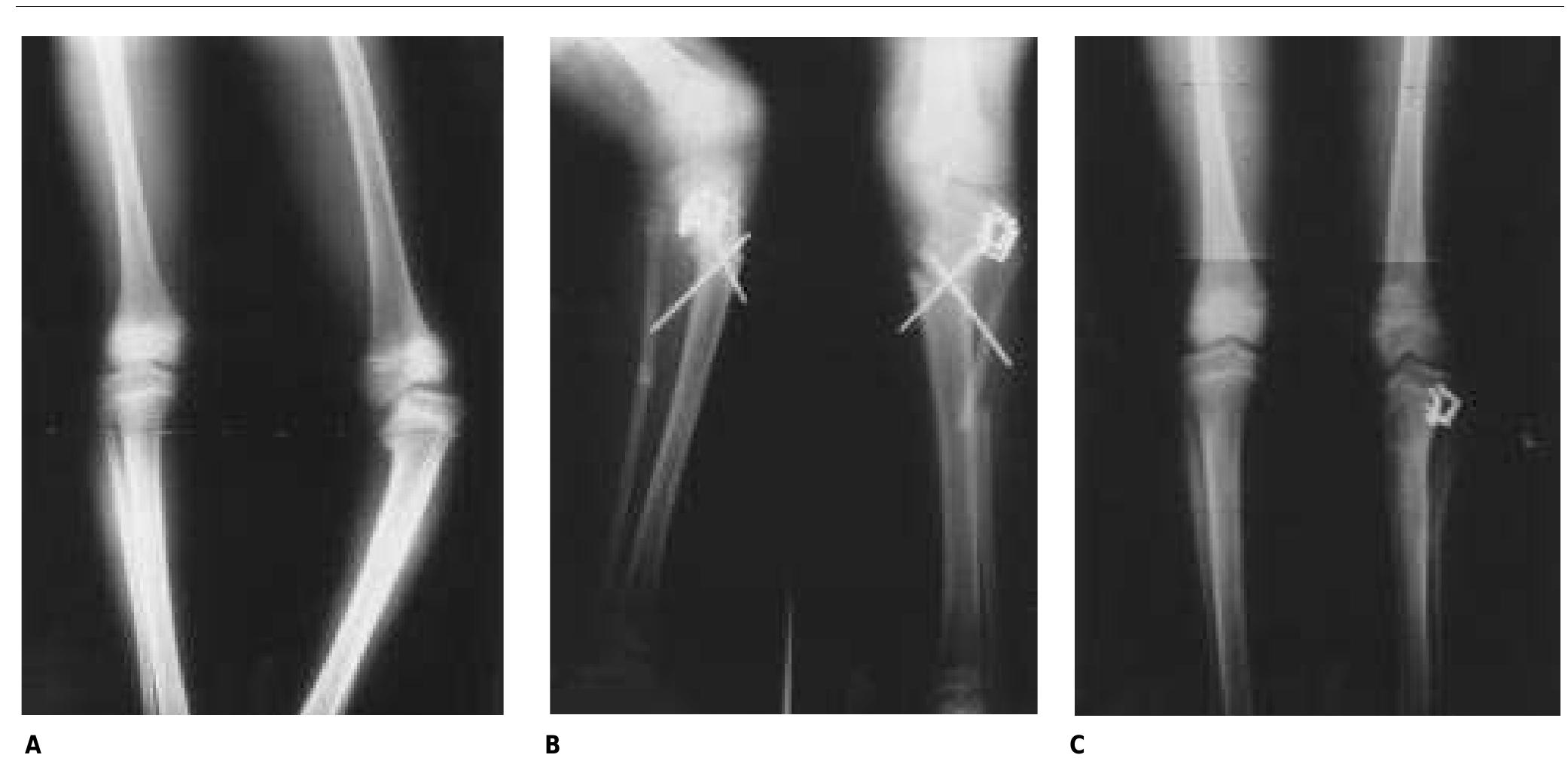 Figure 6 - from Genu Varum in Children: Diagnosis and