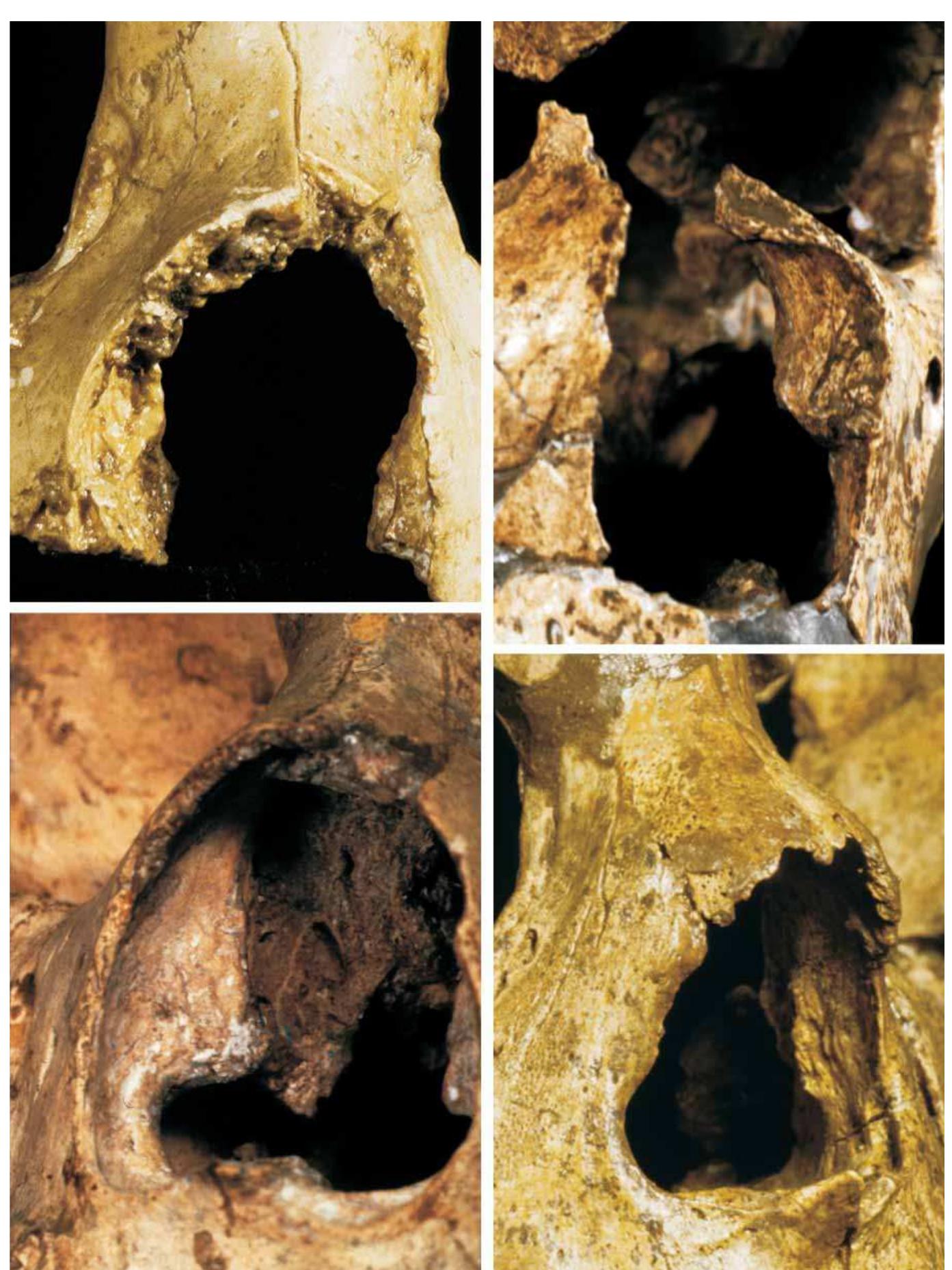 Nasal regions of various neanderthal specimens with variably