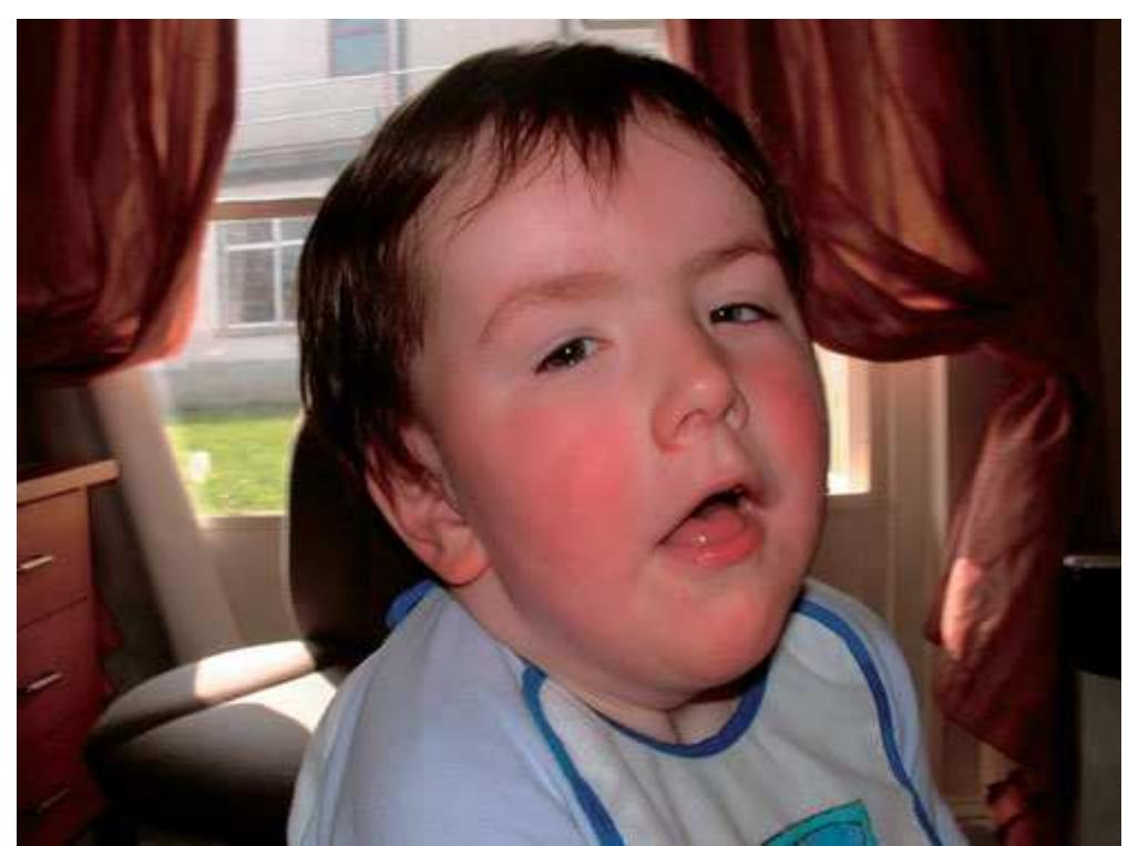 4b a typical example of sotos syndrome is shown. note the