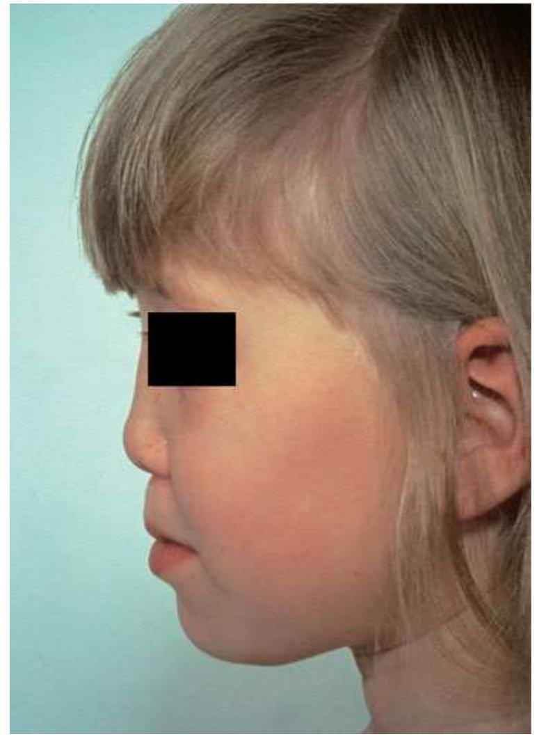 6 a case of binder syndrome is shown. note the flat midface