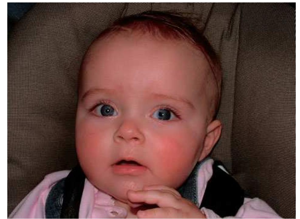 9 the clinical presentation of left-sided ectopic pupil is