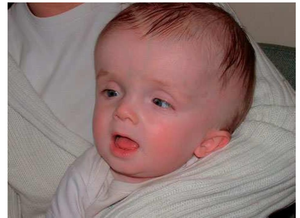 1b low-set ears are demonstrated as a secondary phe- nomenon