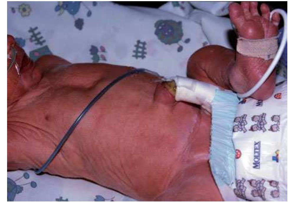 2a the umbilical hernia in this baby with beckwith-