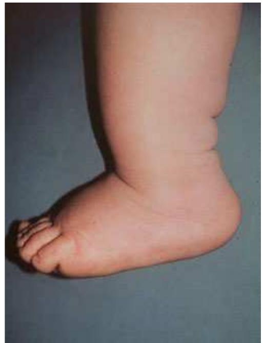 9a a very typical anterior deformity of the lower limb is