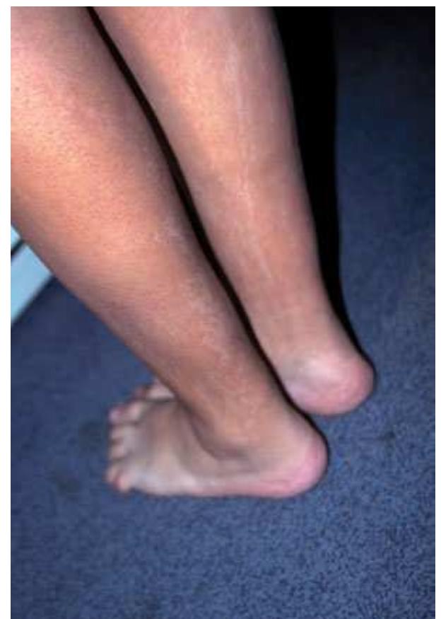 10a typical hypopigmented linear streaky lesions are seen on