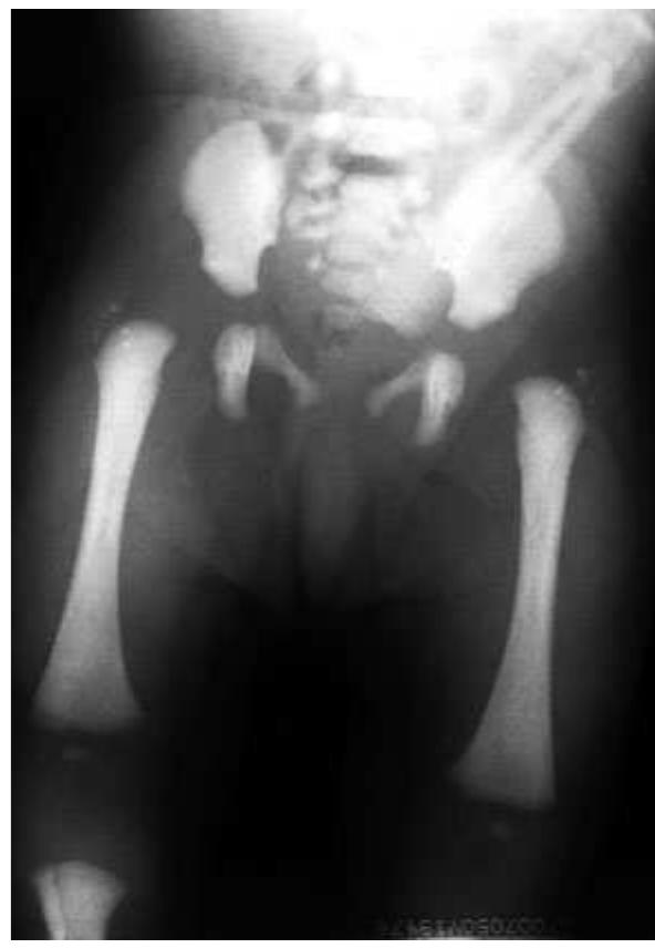 15d punctuate calcification in- volving the hip joints is