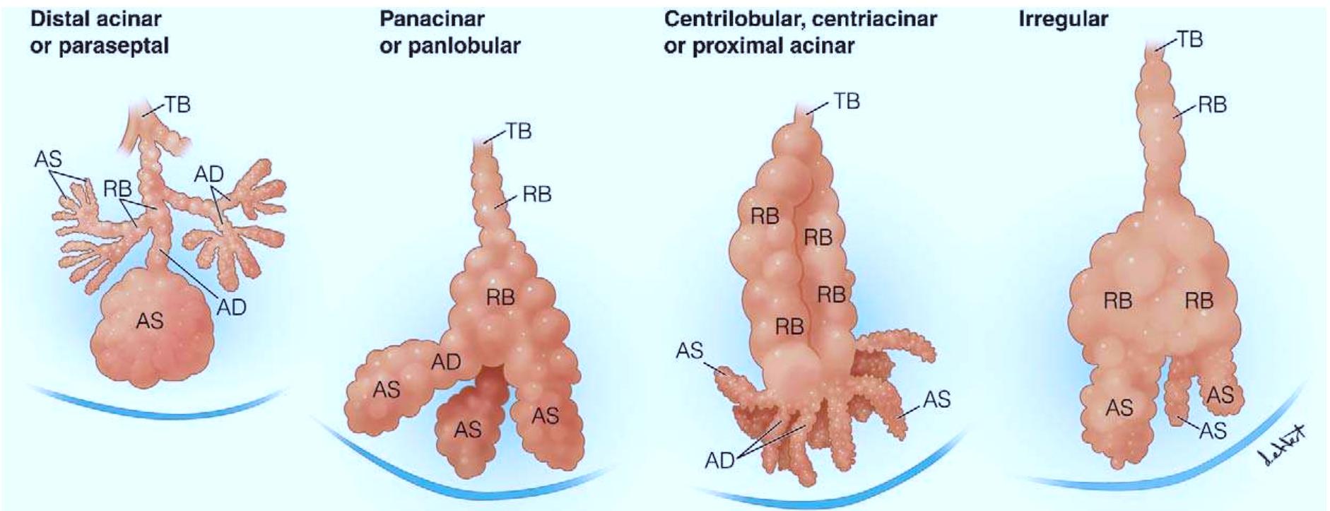 Figure 3 - from Chronic Obstructive Pulmonary Disease: