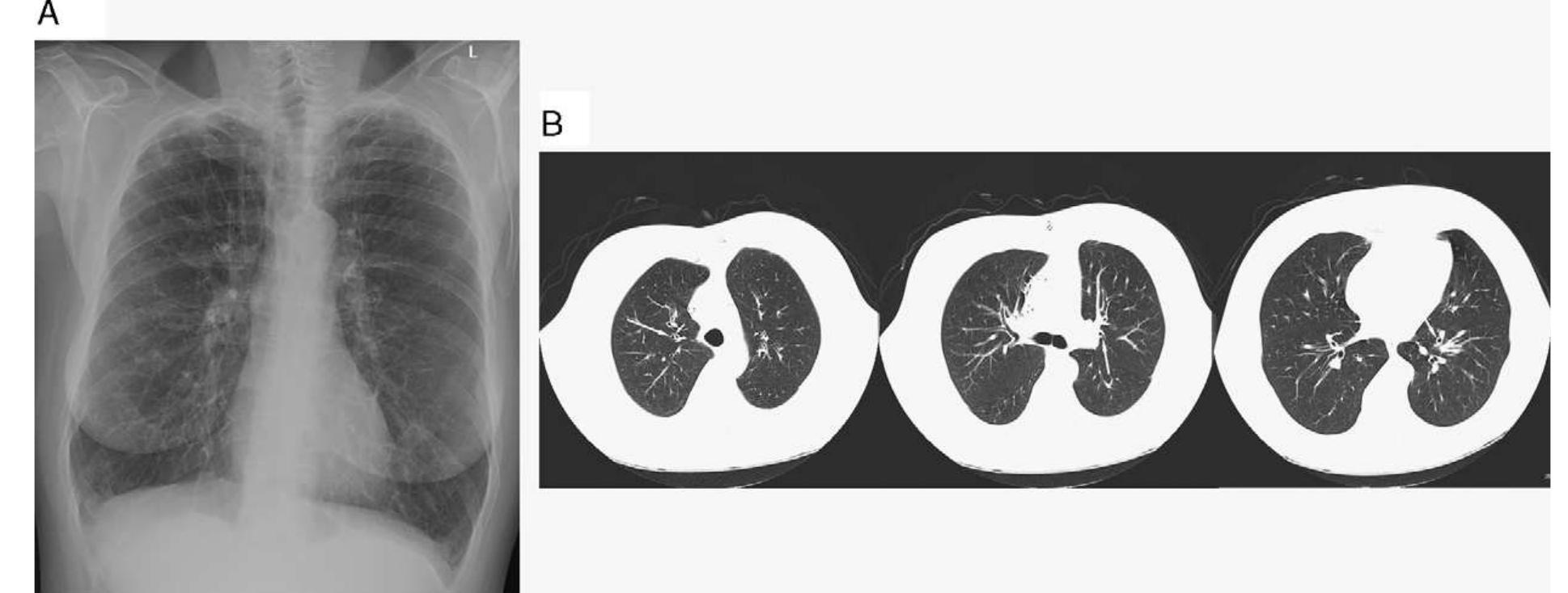 Chronic bronchitis: postero-anterior radiograph (a) and
