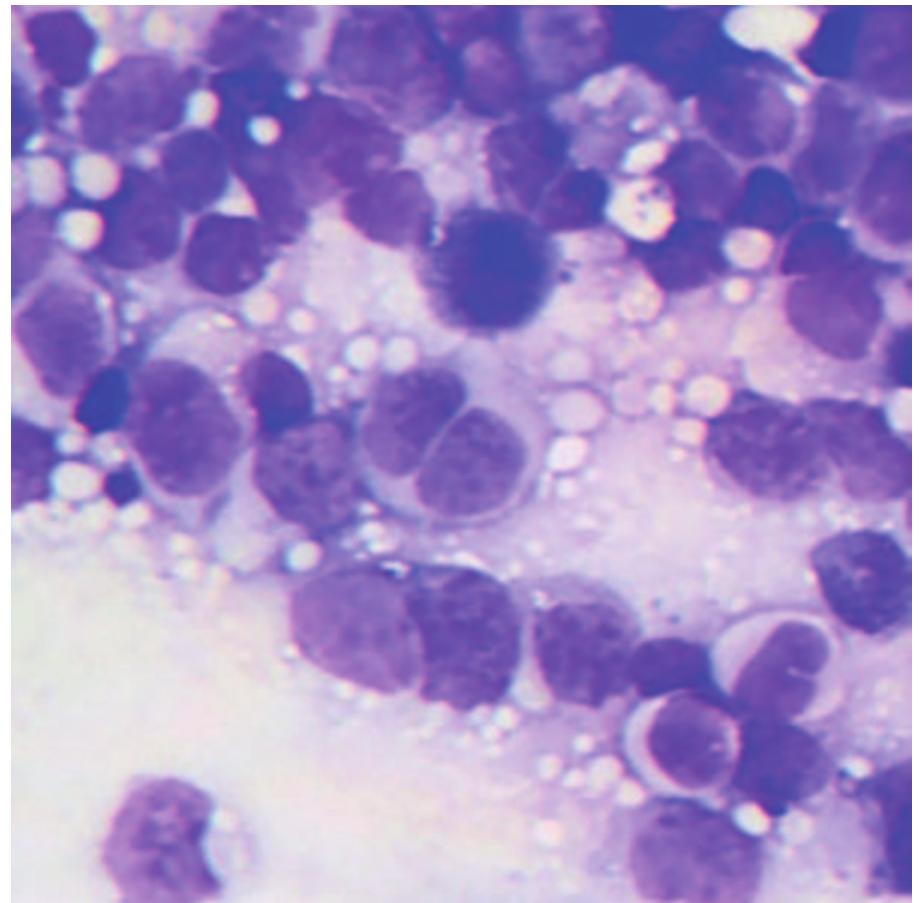 27 round cells from a lymph node aspirate.