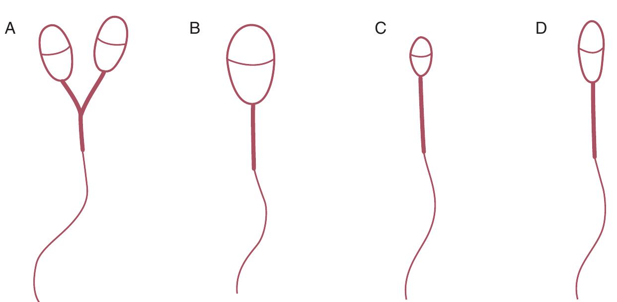 Primary and acrosomal spermatozoal abnormalities