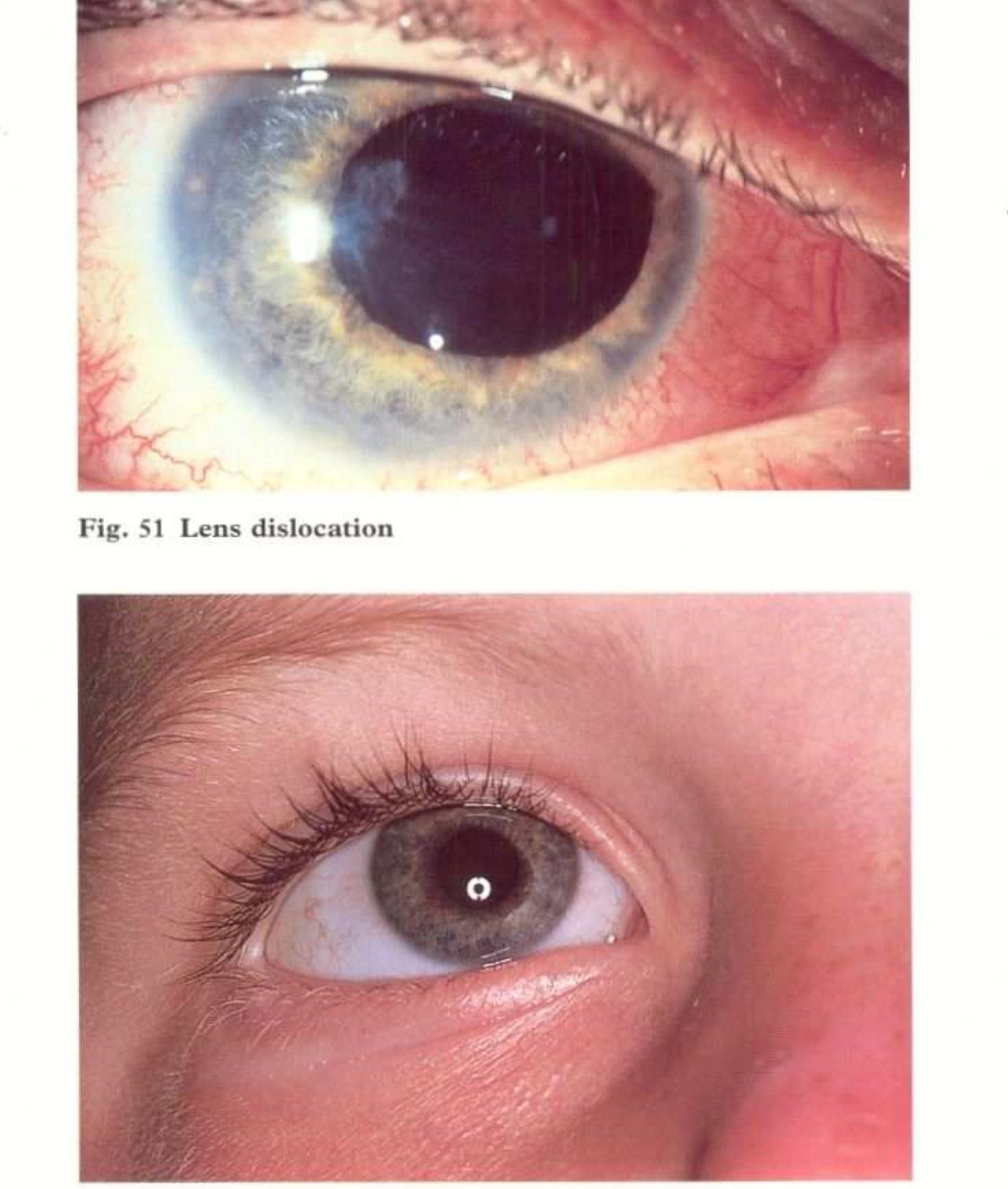 Osteogenesis imperfecta fig. 51 lateral displacement of the