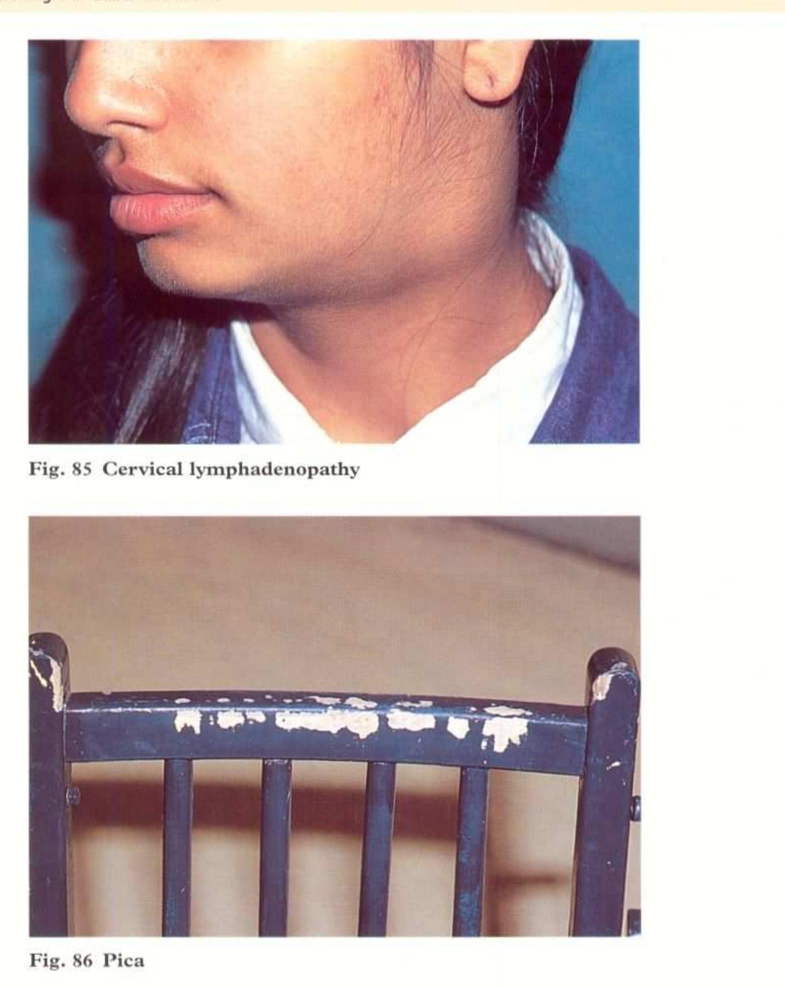 ‘ig. 85 a mass is visible in the submandibular region of